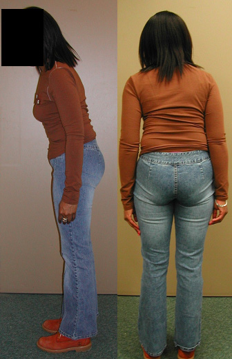 Spine Case | Previous Harrington Rod Causing Low Back Pain