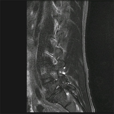 L5-S1 Spondylolisthesis in a Young Female, Previous Gymnast