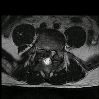 L5-S1 Spondylolisthesis in a Young Female, Previous Gymnast