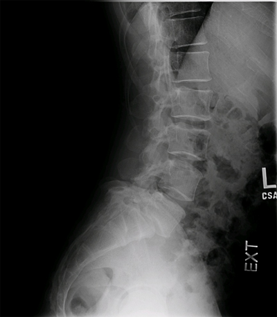 L5-S1 Spondylolisthesis in a Young Female, Previous Gymnast
