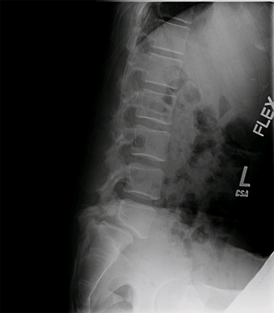 L5-S1 Spondylolisthesis in a Young Female, Previous Gymnast