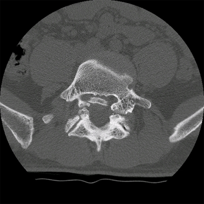 L5-S1 Spondylolisthesis in a Young Female, Previous Gymnast