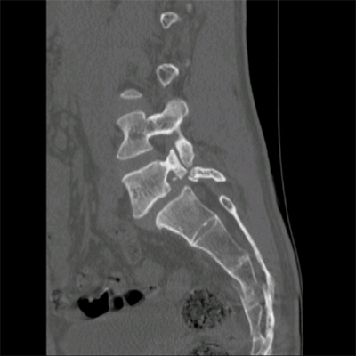 L5-S1 Spondylolisthesis in a Young Female, Previous Gymnast