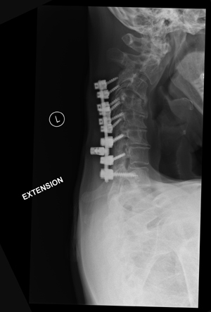 Fusion Nonunion with Progressive Kyphosis