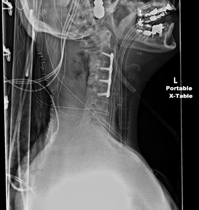 Fusion Nonunion with Progressive Kyphosis
