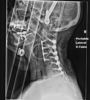 Fusion Nonunion with Progressive Kyphosis