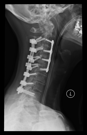 Fusion Nonunion with Progressive Kyphosis