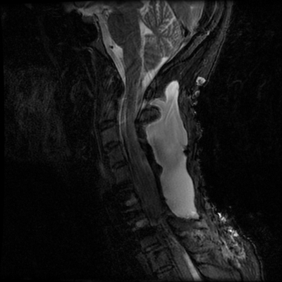 Cervical Nonunion and Kyphosis