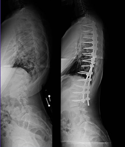 Adolescent Idiopathic Scoliosis in a 17-year-old Boy