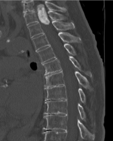 Intradural Calcified Thoracic Meningioma