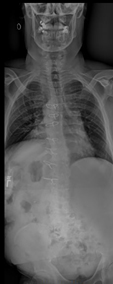 Severe Sagittal Imbalance and Lumbar Spinal Stenosis in a Patient with ...