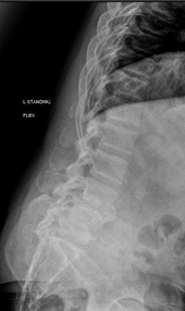 Severe Sagittal Imbalance and Lumbar Spinal Stenosis in a Patient with ...