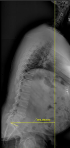 Severe Sagittal Imbalance and Lumbar Spinal Stenosis in a Patient with ...