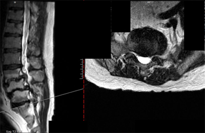 Severe Sagittal Imbalance and Lumbar Spinal Stenosis in a Patient with ...