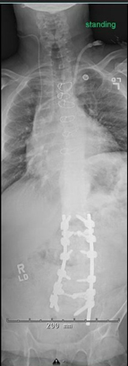 Severe Sagittal Imbalance and Lumbar Spinal Stenosis in a Patient with ...