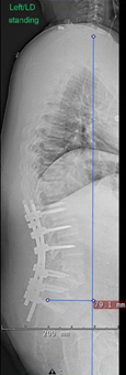 Severe Sagittal Imbalance and Lumbar Spinal Stenosis in a Patient with ...