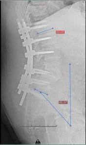 Severe Sagittal Imbalance and Lumbar Spinal Stenosis in a Patient with ...