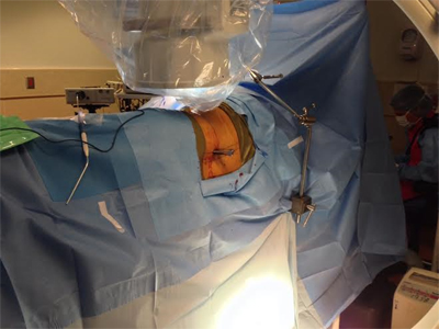 L4-L5 Foraminal Spinal Stenosis in an Elderly Male