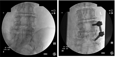 L4-L5 Foraminal Spinal Stenosis in an Elderly Male
