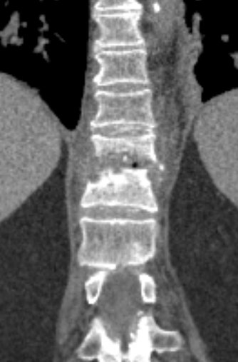 T10, T11 Osteomyelitis