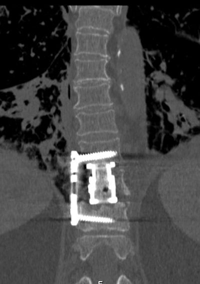 T10, T11 Osteomyelitis