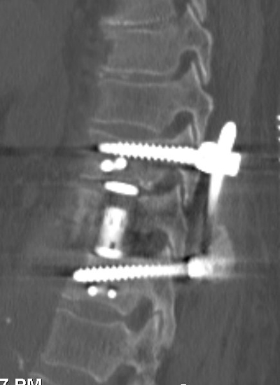 T10, T11 Osteomyelitis