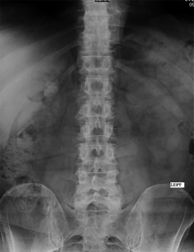 Worsening Leg Weakness with a Negative Lumbar MRI