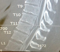 Large Partially Calcified Thoracic Disc Herniation