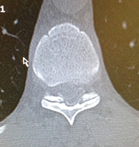 Large Partially Calcified Thoracic Disc Herniation