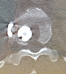 Large Partially Calcified Thoracic Disc Herniation