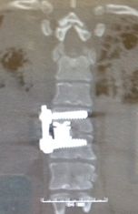 Large Partially Calcified Thoracic Disc Herniation