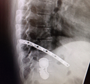 Large Partially Calcified Thoracic Disc Herniation