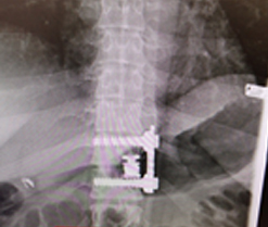 Large Partially Calcified Thoracic Disc Herniation