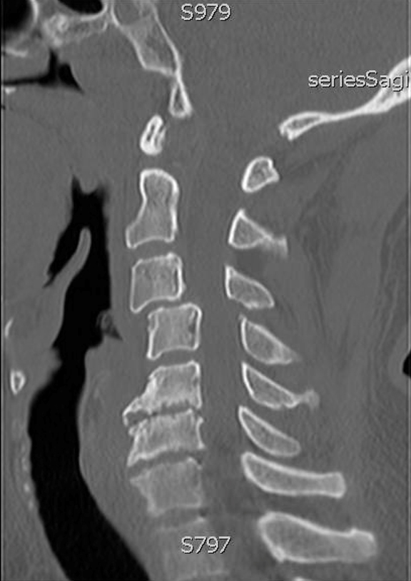 Cervical Spondylolisthesis and Stenosis With Myelopathy