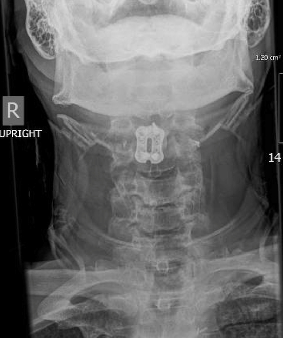 Cervical Spondylolisthesis and Stenosis With Myelopathy