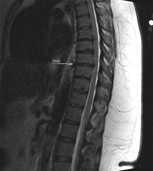 Severe Thoracic Pain Leads to Spinal Fusion