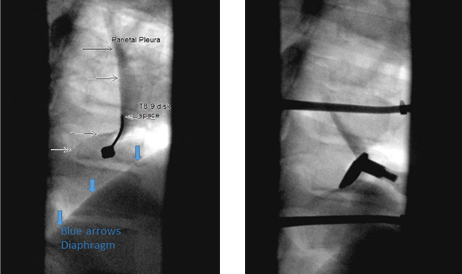 Severe Thoracic Pain Leads to Spinal Fusion