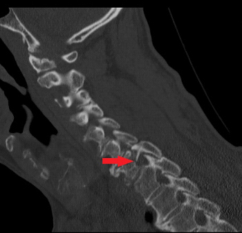 Failure to Recognize Traumatic Cervical Spinal Instability, C7-T1 ...