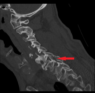 Failure to Recognize Traumatic Cervical Spinal Instability, C7-T1 ...