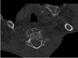 Failure to Recognize Traumatic Cervical Spinal Instability, C7-T1 ...