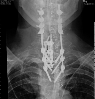 Failure to Recognize Traumatic Cervical Spinal Instability, C7-T1 ...