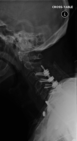 Failure to Recognize Traumatic Cervical Spinal Instability, C7-T1 ...