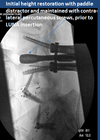Superior Articular Facet Interbody Reconstruction (SAFIR)