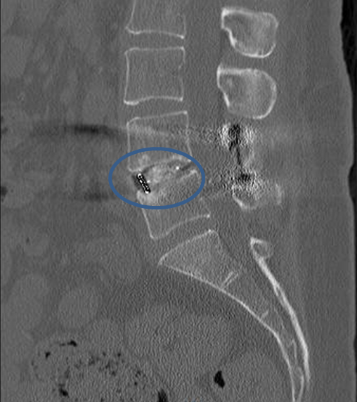 Severe Lumbar Spinal Stenosis with Spondylolisthesis