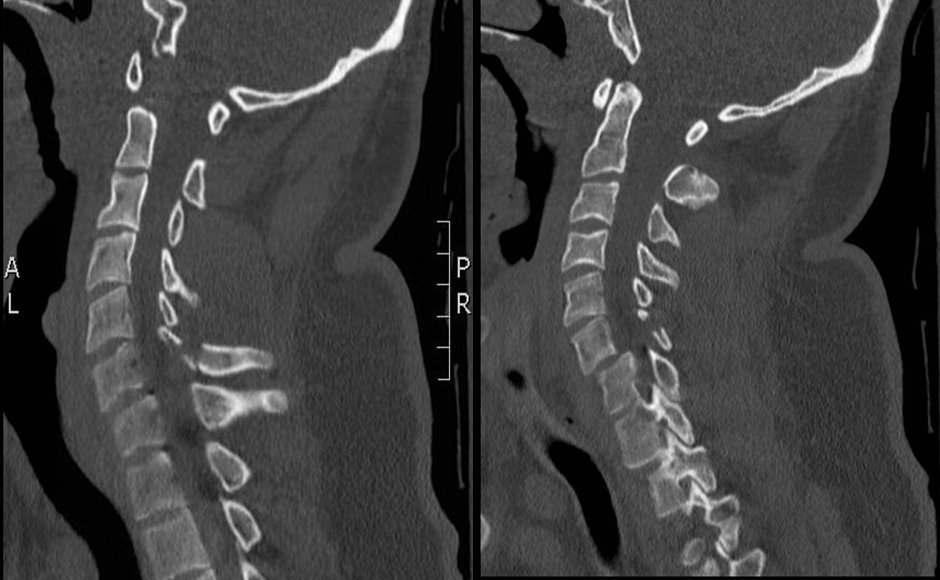 Traumatic Unilateral Cervical Spine Perched Facet