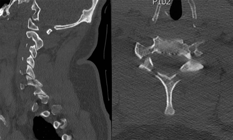 Traumatic Unilateral Cervical Spine Perched Facet