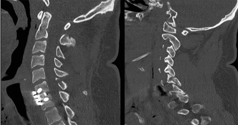 Traumatic Unilateral Cervical Spine Perched Facet