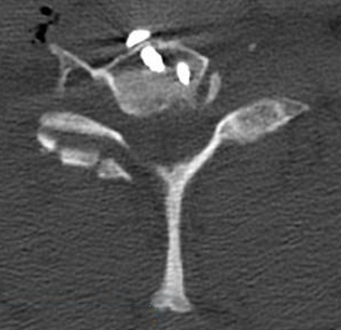 Traumatic Unilateral Cervical Spine Perched Facet