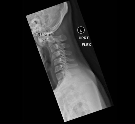 C2 Spine Fracture