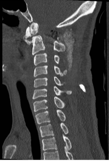 Chronic Type II Odontoid Fracture With C1-C2 Instability and Severe ...